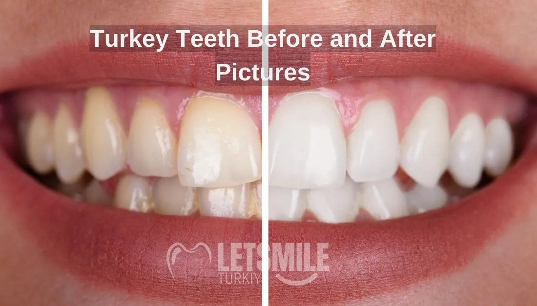 Turkey Teeth Before And After Pictures 2025